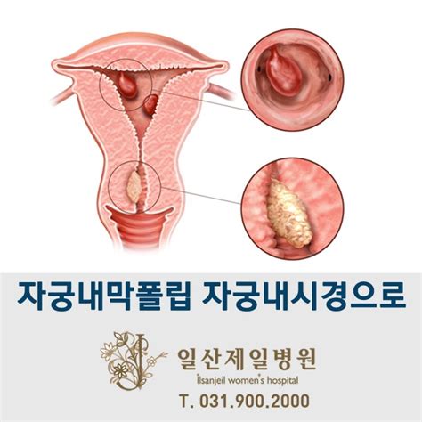 일산난임 자궁내막폴립 김포난임 파주자궁용종 네이버 블로그