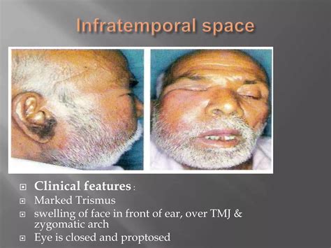Maxillary Space Infection Pptx