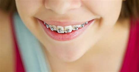¿cómo Saber Si Tu Niñoa Necesita Brackets