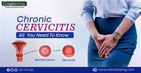 Chronic Cervicitis All You Need To Know About