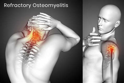 Hyperbaric Treatment Of Chronic Refractory Osteomyelitis Hyperbaric Oxygen Therapy Hbot