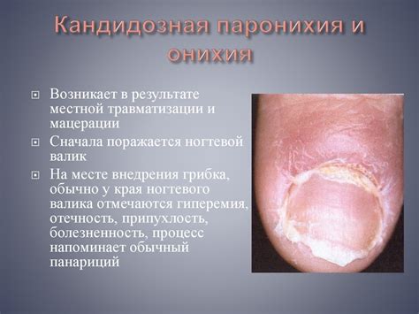 Особенности клинической картины кандидозной инфекции презентация онлайн