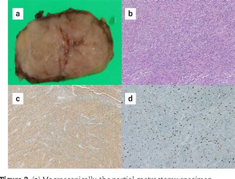 Figure 3 From Robot Assisted Laparoscopic Partial Gastrectomy Combined