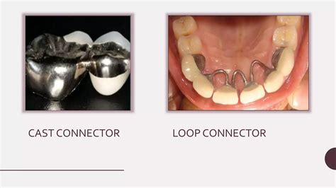 Parts Of Fixed Partial Denture Pptx