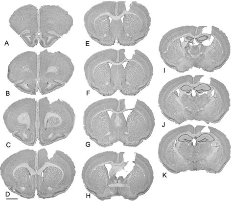 The Extent Of Gross Morphology Of The Cortical Aspiration Lesion In A