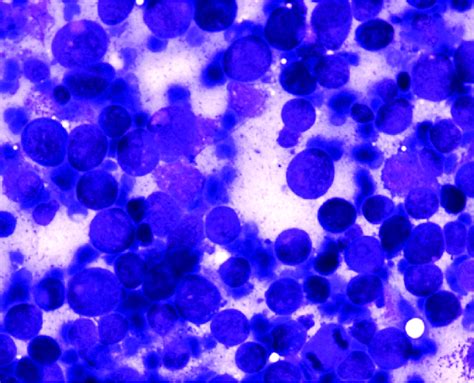 Malignant Myelocytic Cell Infiltration In Bone Marrow Aspiration
