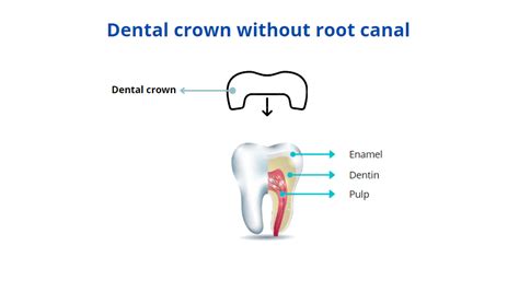 Crown Without Root Canal Is It Possible And What To Expect