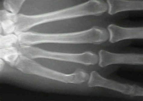 Boxers Fracture Metacarpal Neck Wheeless Textbook Of Orthopaedics
