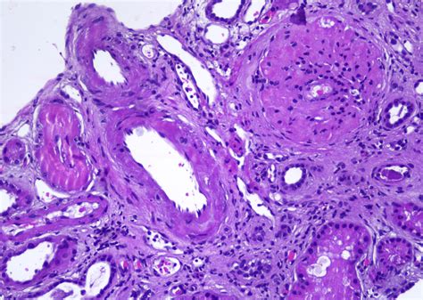 Pathology Outlines Malignant Hypertension And Accelerated Nephrosclerosis