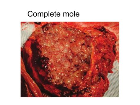 Molar Pregnancy Complete Vs Incomplete Hydatidiform Molepptxpptx Pptx