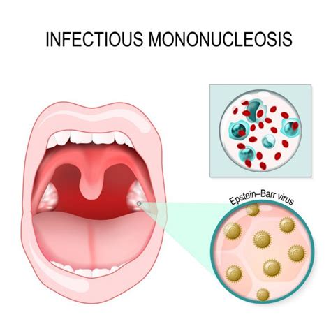 Epstein Barr Virus Types Symptoms Treatment Home Remedies Std Gov