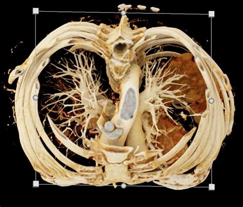 Mediastinal Mass Was Ectopic Parathyroid Gland Chest Radiology Case