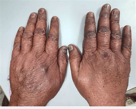 Paclitaxel Induced Adr Image Showing Nail Plate Pigmentation And