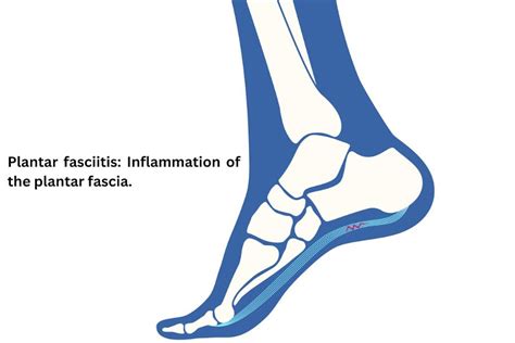 What Is Plantar Fasciitis