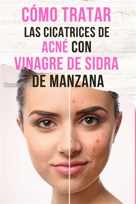 Vinagre De Manzana Para Las Manchas Artofit