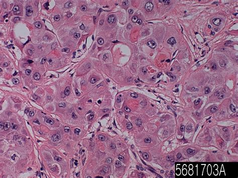 Liver Hepatocellular Carcinoma Xelonet