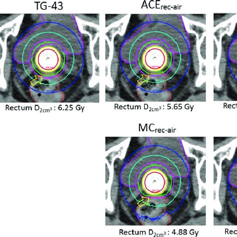Five Dose Distributions For Case 5 Vaginal Cylinder Were Calculated Download Scientific