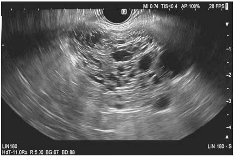 Serous Cystadenoma Ultrasound