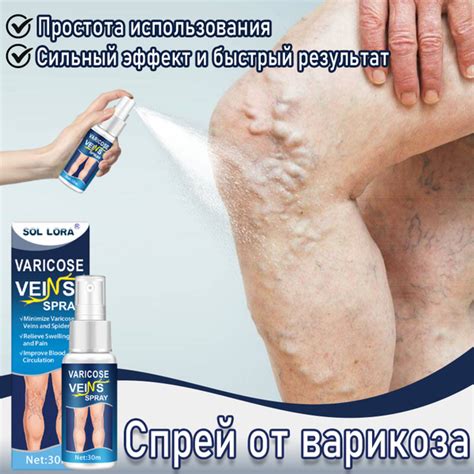 SOL LORA Спрей от варикоза, 30мл , эффективен при сосудистых звездочках ...