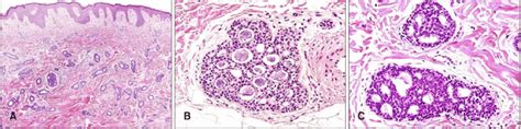 Histopathologic Features Of The Excised Tumor A Basaloid Tumor Cells