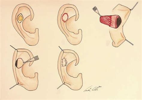 The Mid Moon Flap Technique For The Reconstruction Of Auricular Download Scientific Diagram