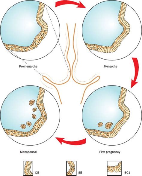 Cervical Cancer Screening And Preinvasive Disease Oncohema Key