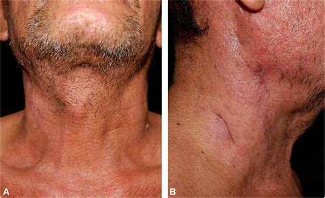 Nontuberculous Scrofuloderma With Sweet Syndrome Leading To Anti Interferon γ Autoantibody Nontuberculous Scrofuloderma With Sweet Syndrome Leading To Anti Interferon γ Autoantibody