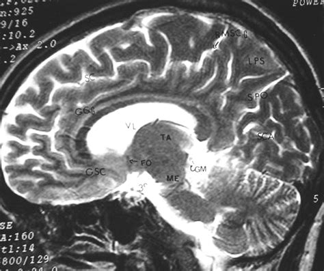 Telencéfalo Corte Sagital Medial Diagram Quizlet