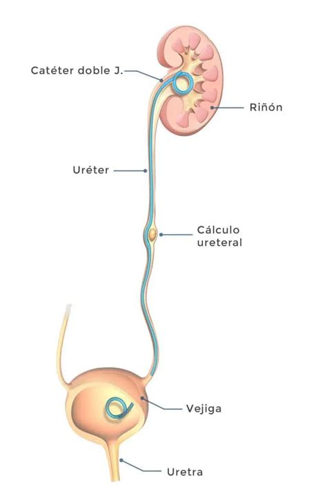 Colocación De Catéter Doble J Centro Médico Pedregal