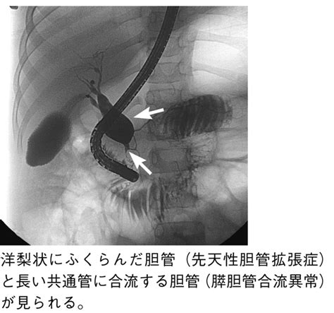 膵胆管合流異常｜肝臓・胆嚢・膵臓の病気｜分類から調べる｜病気を調べる｜病気解説2600項目｜根拠にもとづく医療情報の提供｜家庭の医学 大全科