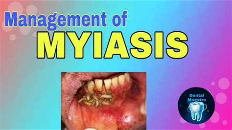 Myasis Cutaneous Myiasis Dermatology Advisor Surface Skin Miases