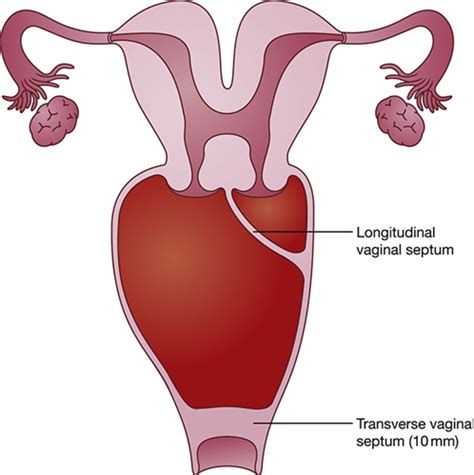 Vách Ngăn âm đạo Bệnh Viện Từ Dũ