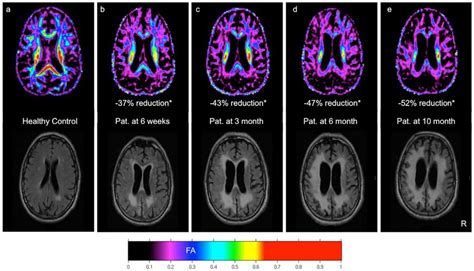 Color Coded Fa Map And Flair Mri Of A 78 Y Old Healthy Control A Dti Download Scientific