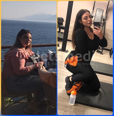 Gastric Sleeve Manchester Bariatric Surgery Letsmedi
