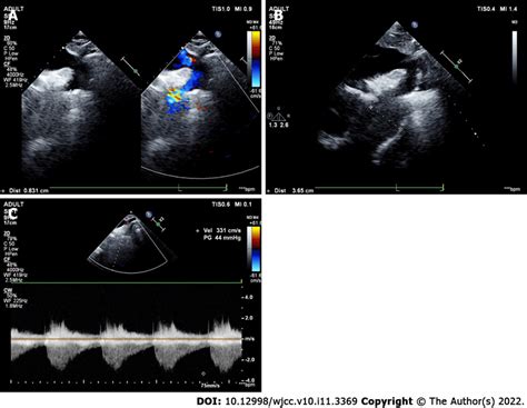 The Long Axis View Of The Aortic Arch Of The Suprasternal Fossa Showed