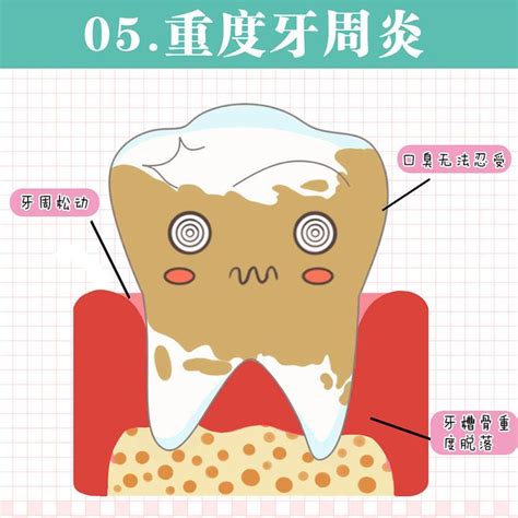 牙周炎究竟有多可怕？竟让90后也陷入掉牙大军！ 知乎