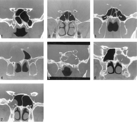 Figure 1 From Benign Expansile Lesions Of The Sphenoid Sinus