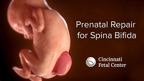 Spina Bifida Causes