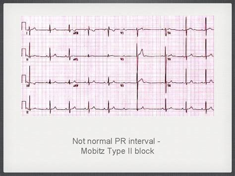 Normal ECG Rate And Rhythm Read Chapters 4