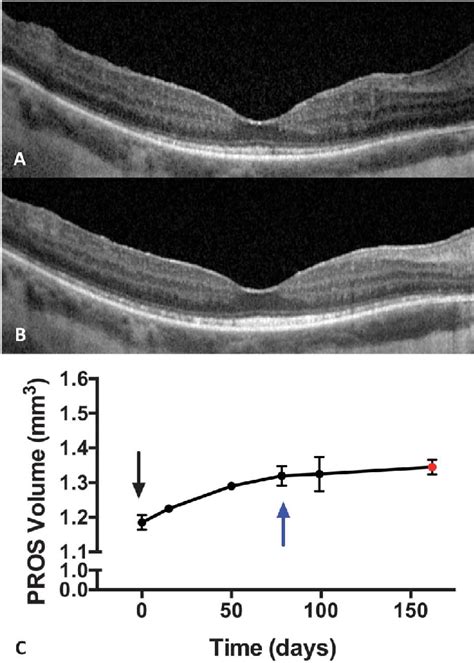 Photoreceptor Outer Segment Volume Increase After Treatment Case 2