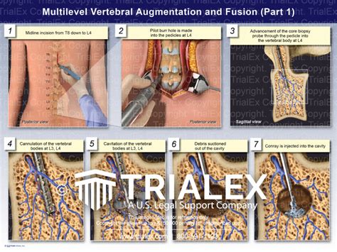 Multilevel Vertebral Augmentation And Fusion Part 1 Trialques