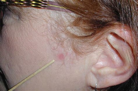 Skincancer Cheek 501b Janjua Facial Surgery