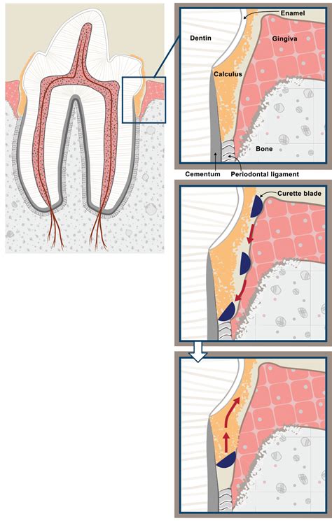 Subgingival Calculus