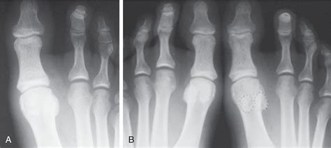 Sesamoids And Accessory Bones Of The Foot Clinical Tree