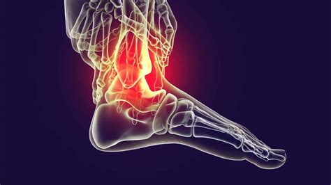 Syndesmosis Injury High Ankle Sprain Optimise Sport Physiotherapy