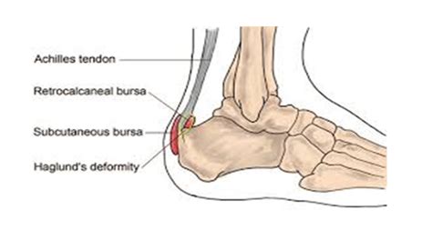 Understanding The Back Of The Heel Bone Structure Function And