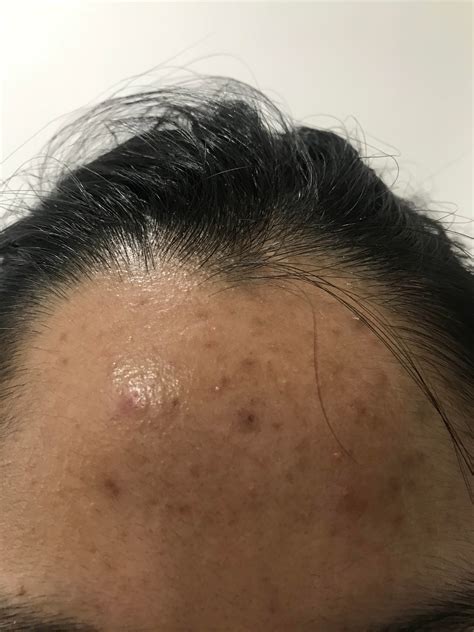 [routine Help] Scars After Using Differin For 3 Months R