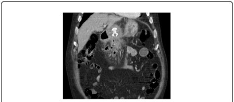 Post Procedure Ct Scan Showing Resolution Of The Pseudocyst After