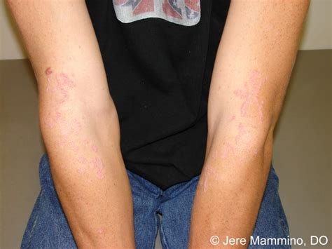 Elastosis Perforans Serpiginosa American Society Of Dermatopathology