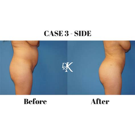 Before And After — Beverly Hills Butt Augmentation